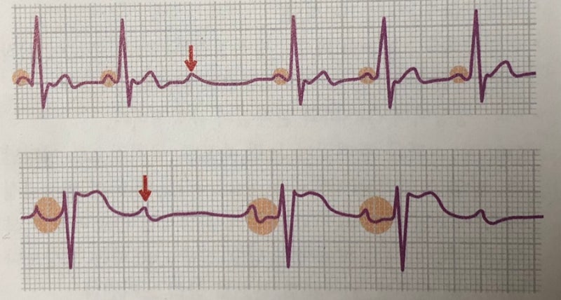 2도 방실차단 : 의학용어 AV block, Mobitz 1,2형 차이점 / 심전도 EKG 리듬 : 네이버 블로그