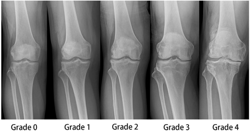 KL grade, Kellgren-Lawrence grade 퇴행성 무릎 관절염 진단 방법, 방사선사진으로 이해하기 : 네이버 블로그