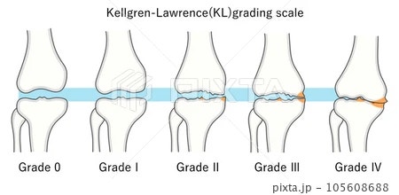 KL grade, Kellgren-Lawrence grade 퇴행성 무릎 관절염 진단 방법, 방사선사진으로 이해하기 : 네이버 블로그