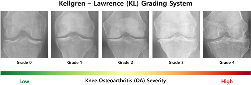 KL grade, Kellgren-Lawrence grade 퇴행성 무릎 관절염 진단 방법, 방사선사진으로 이해하기 : 네이버 블로그