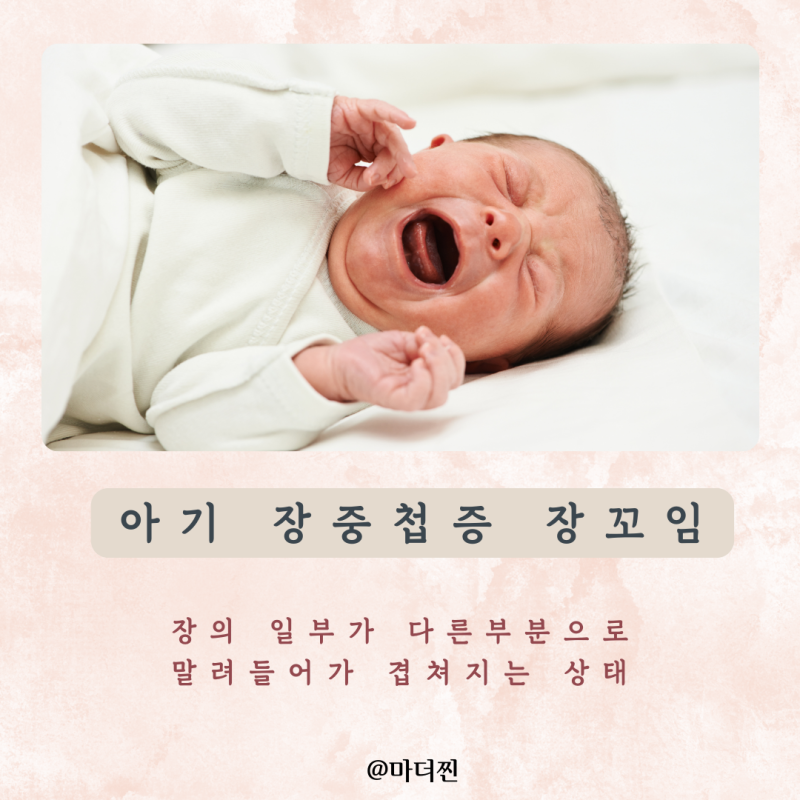 아기 장중첩증 증상 유아 소아 장꼬임 원인 치료방법 네이버 블로그