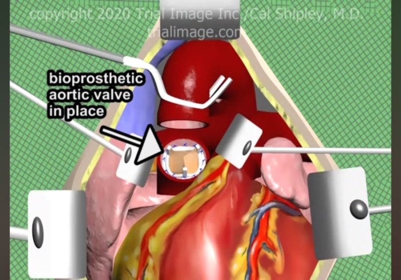 심장판막 수술 MVR (Mitral Valve Repair vs Replacement) : 네이버 블로그