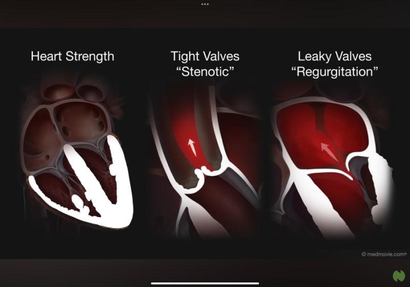 심장판막 수술 MVR (Mitral Valve Repair vs Replacement) : 네이버 블로그