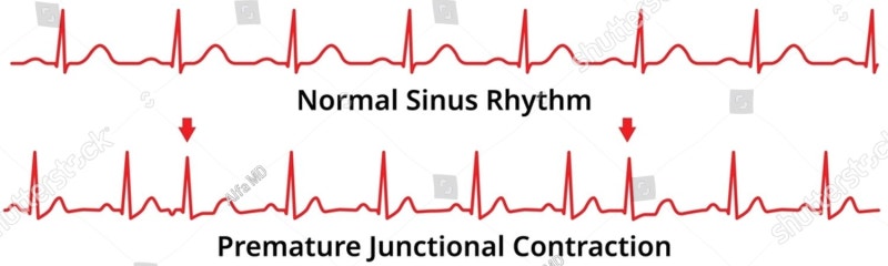 Junctional escape rhythm(방실접합부 리듬), Junctional rhythm, PJC, PSVT ...