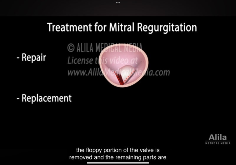 심장판막 수술 MVR (Mitral Valve Repair vs Replacement) : 네이버 블로그