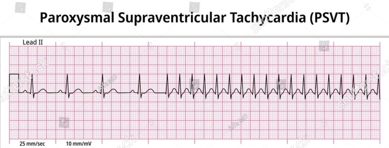 Junctional escape rhythm(방실접합부 리듬), Junctional rhythm, PJC, PSVT ...