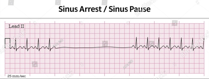 Junctional escape rhythm(방실접합부 리듬), Junctional rhythm, PJC, PSVT ...