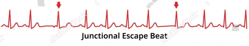 Junctional escape rhythm(방실접합부 리듬), Junctional rhythm, PJC, PSVT ...