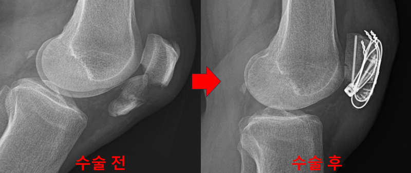 무릎뼈 슬개골 아래극의 심한 분쇄골절 Comminuted Patella Inferior Pole Fracture의 성공적인