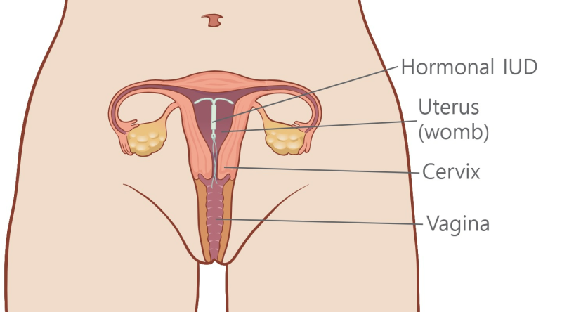 미레나 시술 효과와 부작용 강서구 산부인과 효과와 유지기간 출혈 및 호르몬 부작용 네이버 블로그