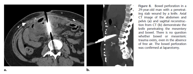 Abdominal stab wound (복부 자상 환자 치료 ) : 네이버 블로그