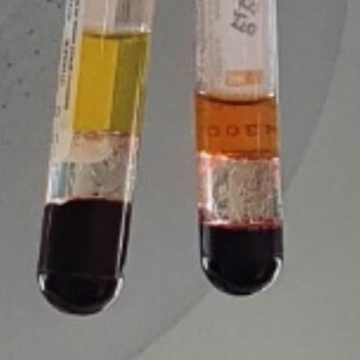 hemolysis, lipemic, Icteric 혈청 : 네이버 블로그