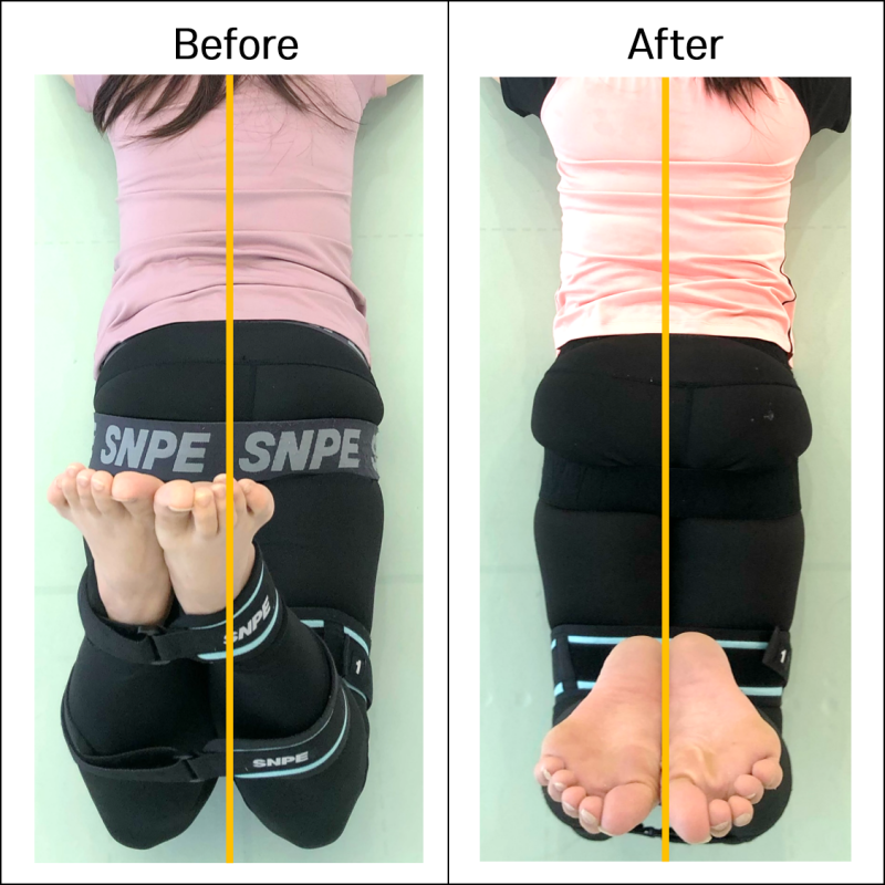 좌우비대칭 개선후기[SNPE 분당 서현점] : 네이버 블로그