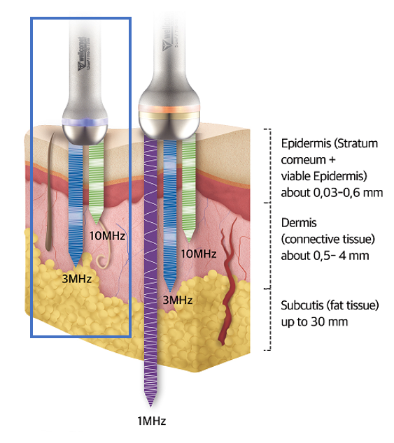 물방울 리프팅 엘디엠(LDM) 관리 효과, 시술시간, 주기, 비용 정리 : 네이버 블로그