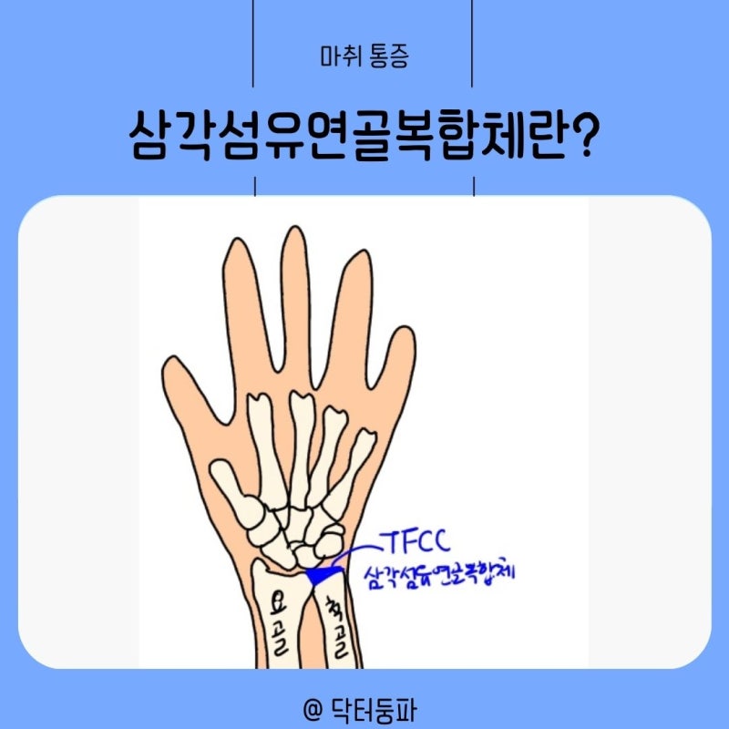 손목 삼각섬유연골복합체 손상 Tfcc 원인 증상 치료 네이버 블로그