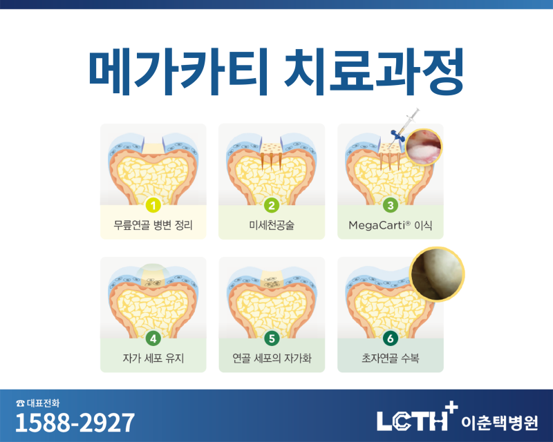 수원정형외과 무릎연골 재생치료 메가카티 Vs 카티리젠 Vs 카티스템 비교 네이버 블로그