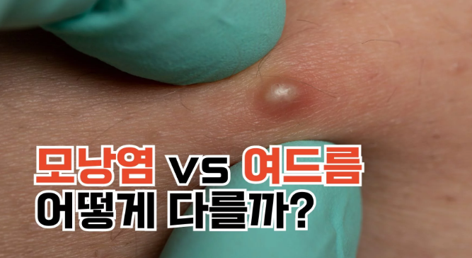 여드름 모낭염 차이 3가지 원인 구분법 치료 방법 네이버 블로그