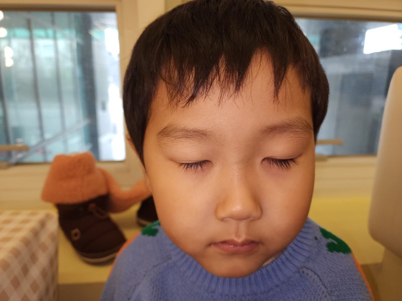 유아 아기 얼굴 백색비강진 백반증 원인 피부과 엑시머 치료 비용 네이버 블로그