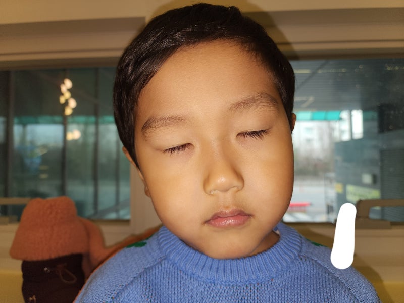유아 아기 얼굴 백색비강진 백반증 원인 피부과 엑시머 치료 비용 네이버 블로그