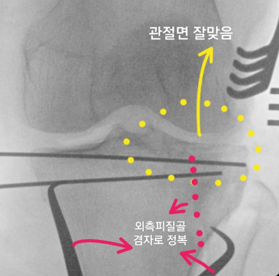 경골 고평부 골절 (Tibia plateau Fracture) 가장 난이도 있는 무릎 골절 수술의 재활 방법과 보행 영상 소개 ...