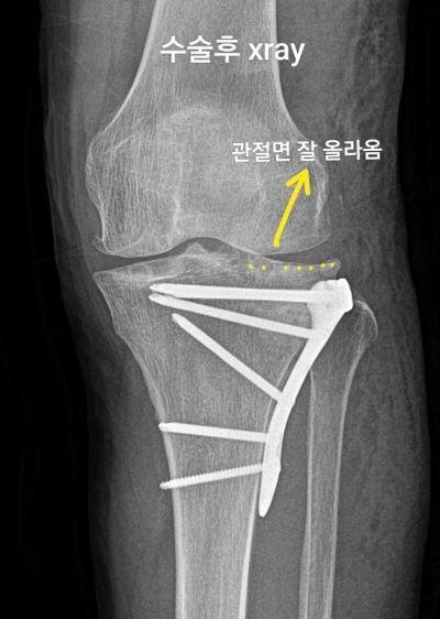 경골 고평부 골절 (Tibia plateau Fracture) 가장 난이도 있는 무릎 골절 수술의 재활 방법과 보행 영상 소개 ...