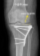 경골 고평부 골절 (Tibia plateau Fracture) 가장 난이도 있는 무릎 골절 수술의 재활 방법과 보행 영상 소개 ...