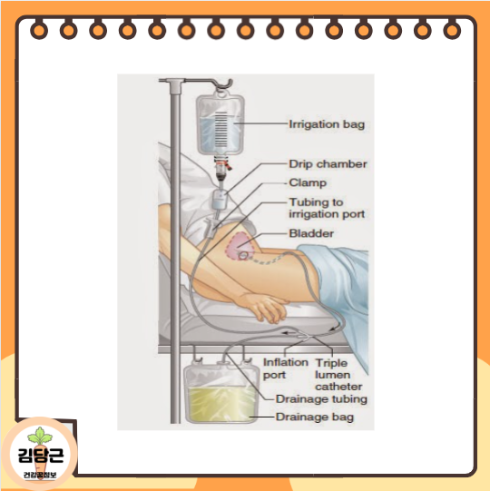 bladder irrigation 방광세척 지속적방광세척 하는방법 : 네이버 블로그