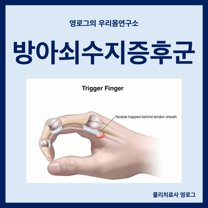 방아쇠수지증후군 원인 증상 운동 및 치료방법 네이버 블로그