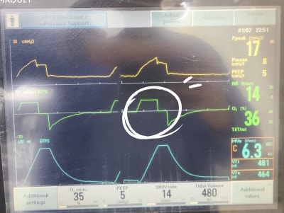 인공호흡기(Ventilator) 적응증과 원리 및 용어 의미 : 네이버 블로그