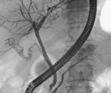 의학용어 ERCP :: 췌담도내시경 정의, 목적, 주의사항 & ENBD ENPD ERBD : 네이버 블로그