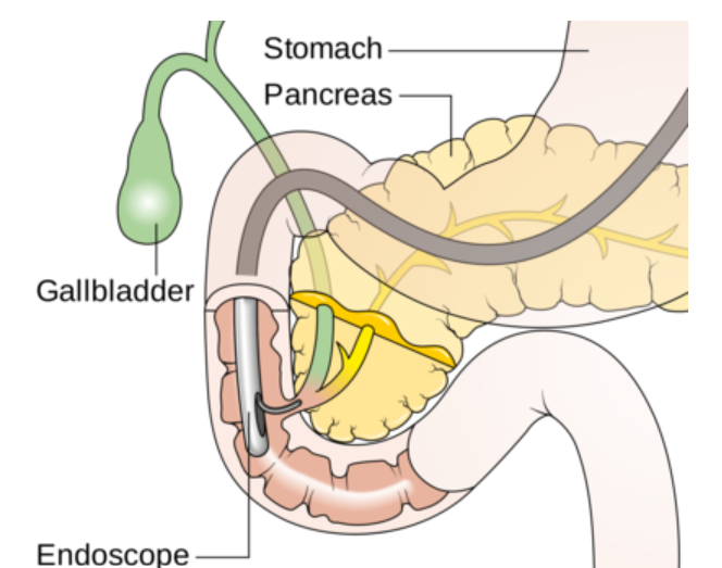 의학용어 ERCP :: 췌담도내시경 정의, 목적, 주의사항 & ENBD ENPD ERBD : 네이버 블로그