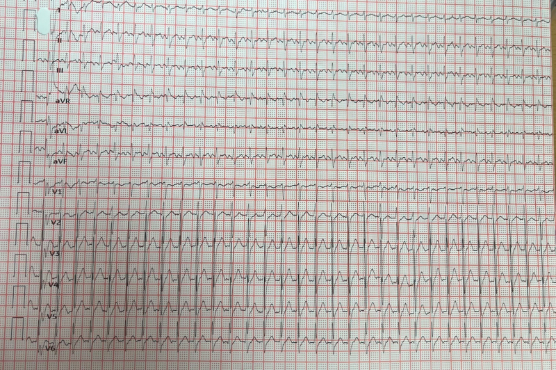 Narrow QRS tachycardia에서 감별진단을 위한 아데노신 투여 : 네이버 블로그