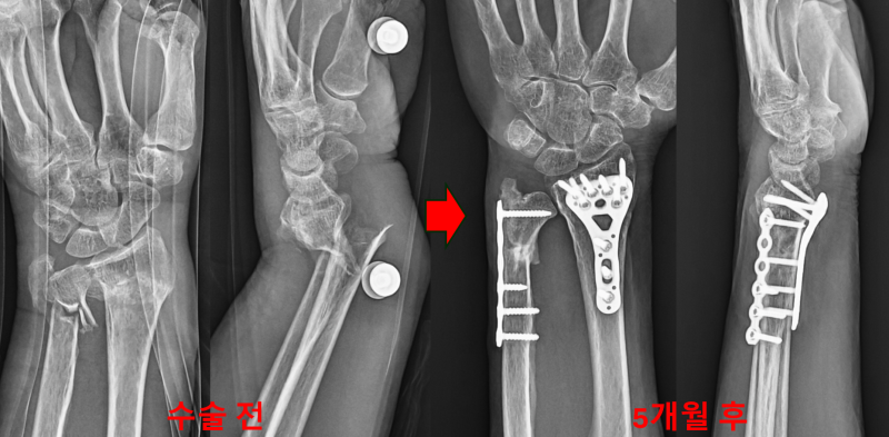 80세 환자의 심한 손목 골절 원위 요척골 골절 Distal Radioulnar Fracture 수술 후 뼈가 붙을 때까지
