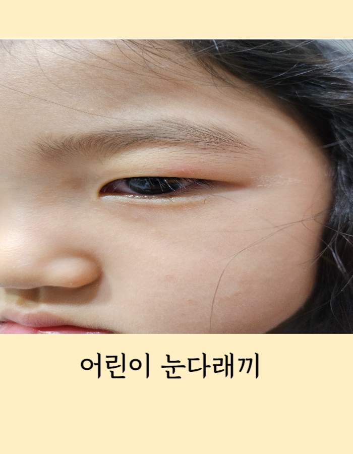 눈다래끼 병원 치료 안약 전염 여부 어린이 겉다래끼 초기증상 네이버 블로그