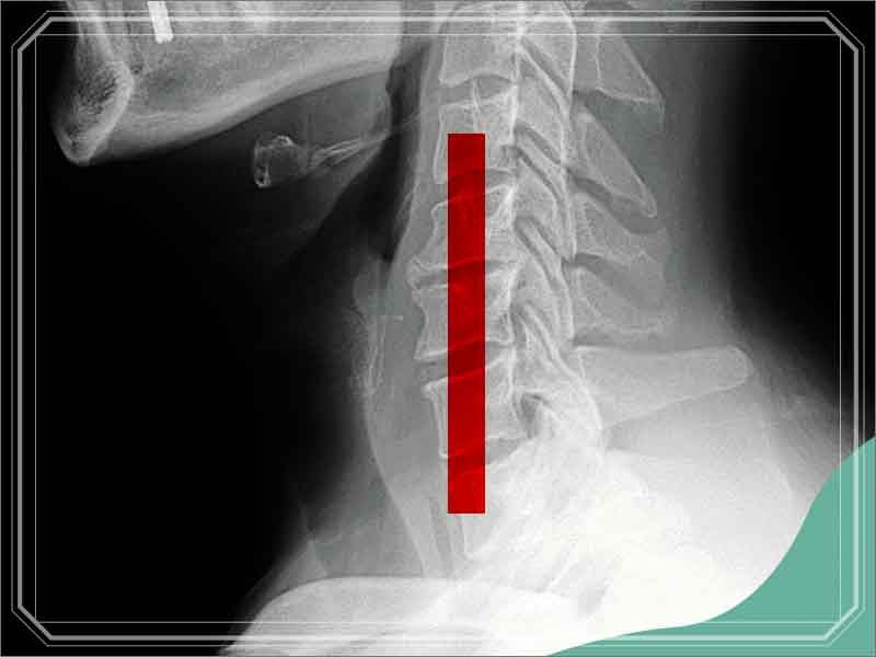 VDT증후군 발생원인, 증상 체크 및 예방법은? : 네이버 블로그