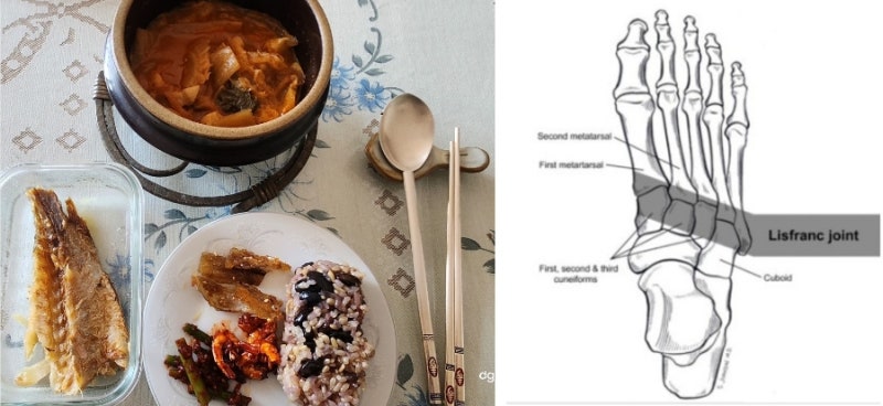 반깁스 2일차 : 남편이 차려준 밥상을 받다, 발뼈골절 리스프랑골절(Lisfranc Fleck sign) : 네이버 블로그