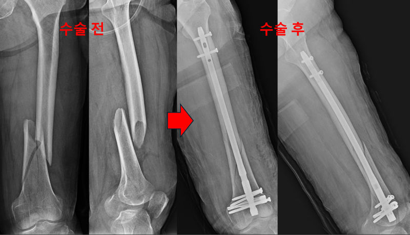 70대 환자의 대퇴골 간부 골절에서 Femur Shaft Fracture 역행성 금속정을 활용한 수술적 치료 및 보행 영상
