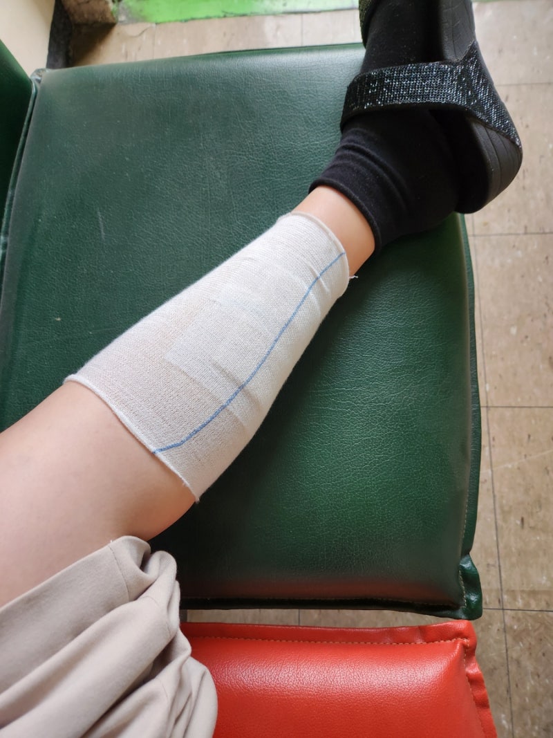 화상치료 후기3베스티안서울병원 화상드레싱 비용 화상따가움 화상 찌르는 통증 네이버 블로그