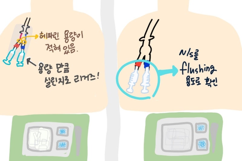 신장 투석실 Perm cath 케스 블리드 방법 및 소독 준비물품 공부하기 : 네이버 블로그