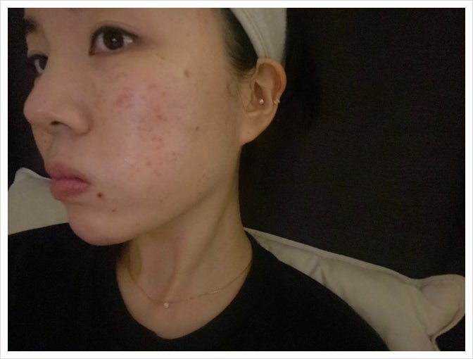 듀얼 피코토닝 Vs 제네시스 레이저 종류 비교 효과 및 가격 And 주기 부작용 네이버 블로그