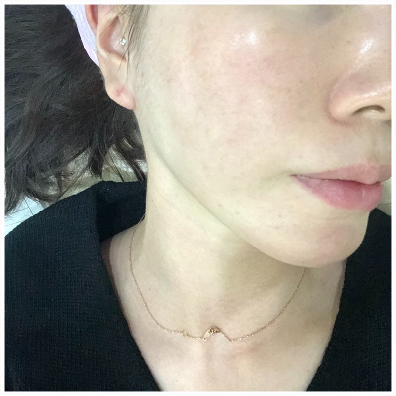 듀얼 피코토닝 Vs 제네시스 레이저 종류 비교 효과 및 가격 And 주기 부작용 네이버 블로그