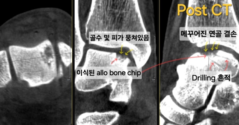 심한 거골 골연골 병변(OLT, osteochondral lesion of talus)의 치료 : 관절경하 BMAC, AMIC ...