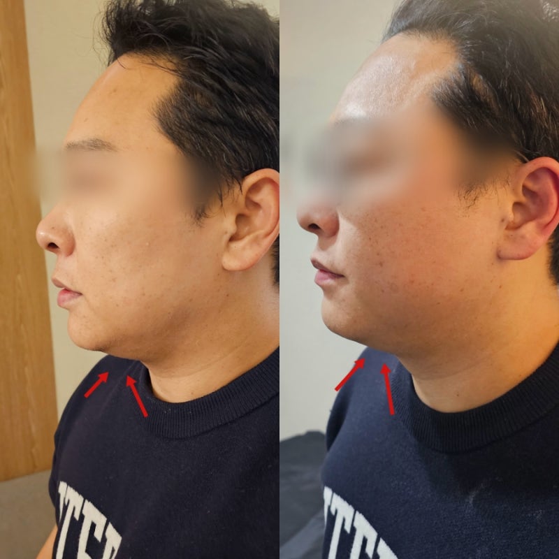 강남 피부과 튠페이스 튠라이너 남자 피부 얼굴형 관리 통증 자국 가격 전후 효과 주기 추천 이중턱살 제거 후기 네이버 블로그