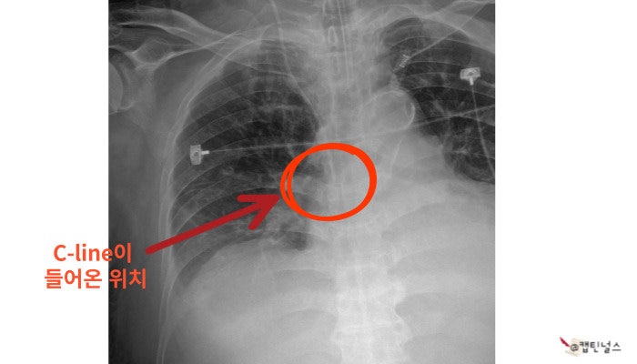 C-line 위치 확인, CVP 중심 정맥압 측정 및 zeroing 방법 : 네이버 블로그