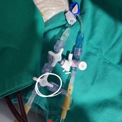 C-line 위치 확인, CVP 중심 정맥압 측정 및 zeroing 방법 : 네이버 블로그