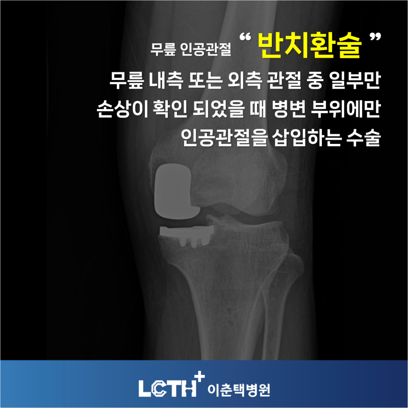 무릎 인공관절 수술 반치환술uka과 전치환술tka 두 수술의 차이점과 인공관절 수술 후 주의사항 네이버 블로그