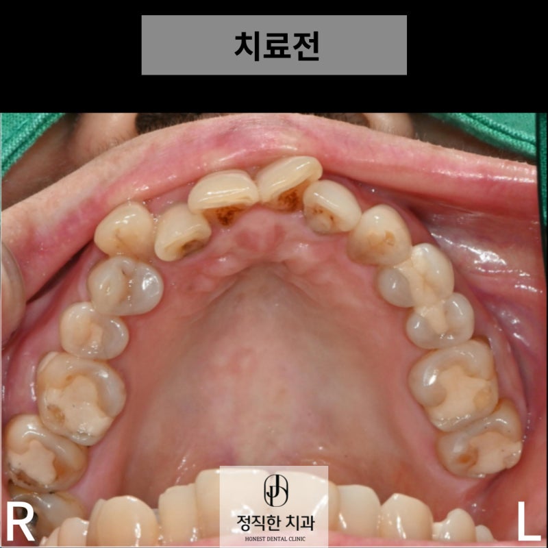 치경부마모증 원인 레진 치료방법 굴곡파절 사례 네이버 블로그
