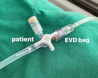 뇌실 외 배액(External Ventricular Drainage, EVD) : 네이버 블로그