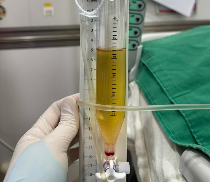 뇌실 외 배액(External Ventricular Drainage, EVD) : 네이버 블로그