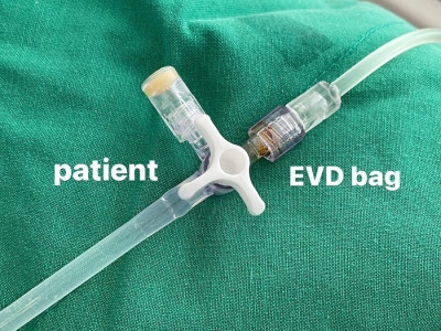 뇌실 외 배액(External Ventricular Drainage, EVD) : 네이버 블로그